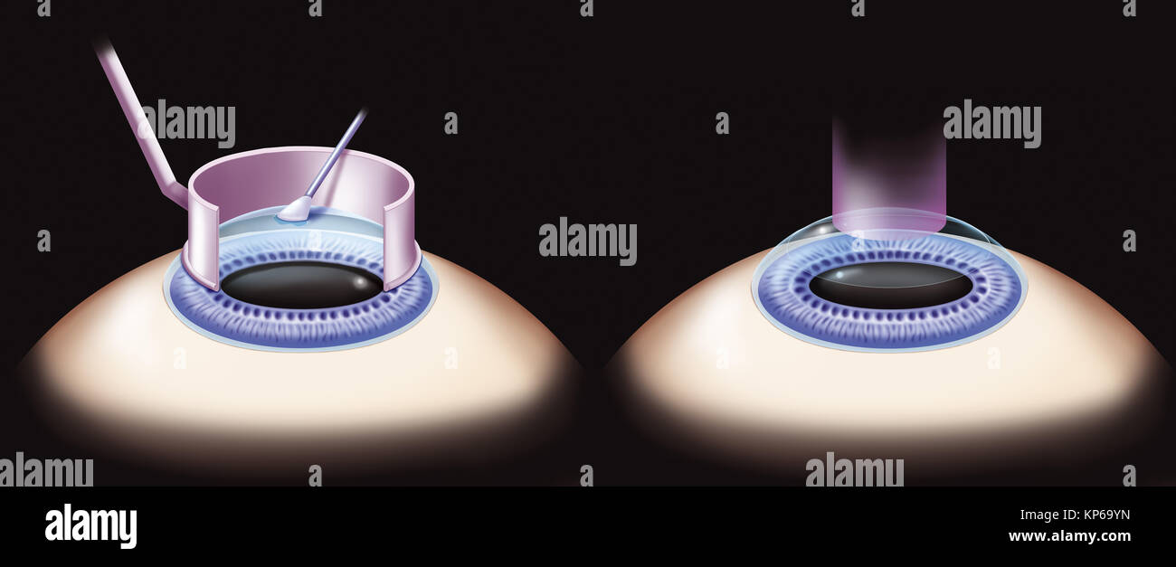 EYE SURGERY, DRAWING Stock Photo - Alamy