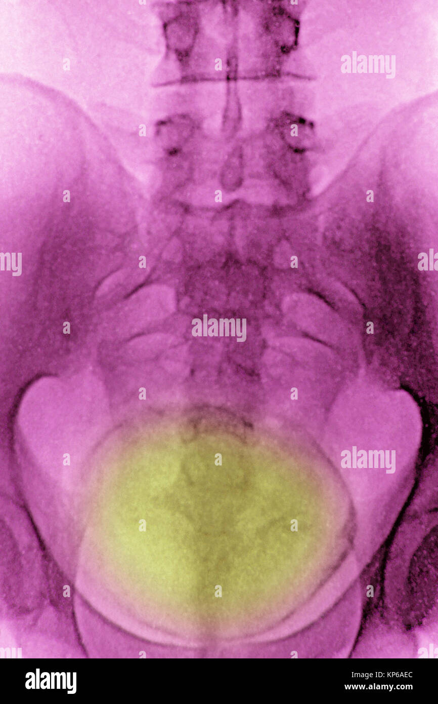 Schistosomiasis hi-res stock photography and images - Alamy