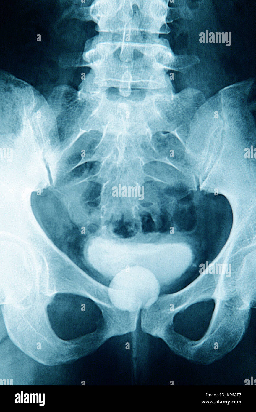 Human bladder hi-res stock photography and images - Alamy