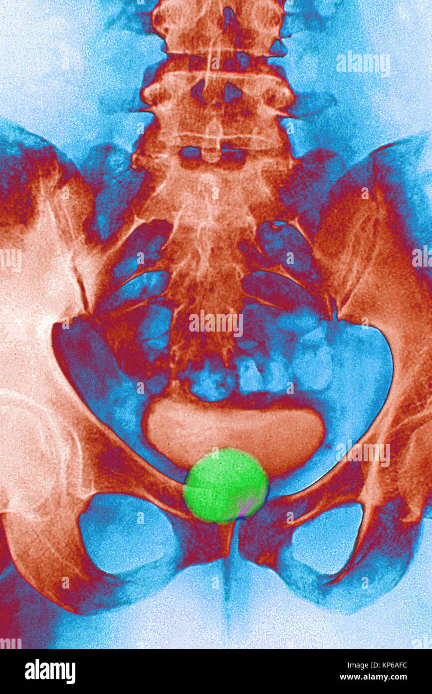 Human bladder hi-res stock photography and images - Alamy