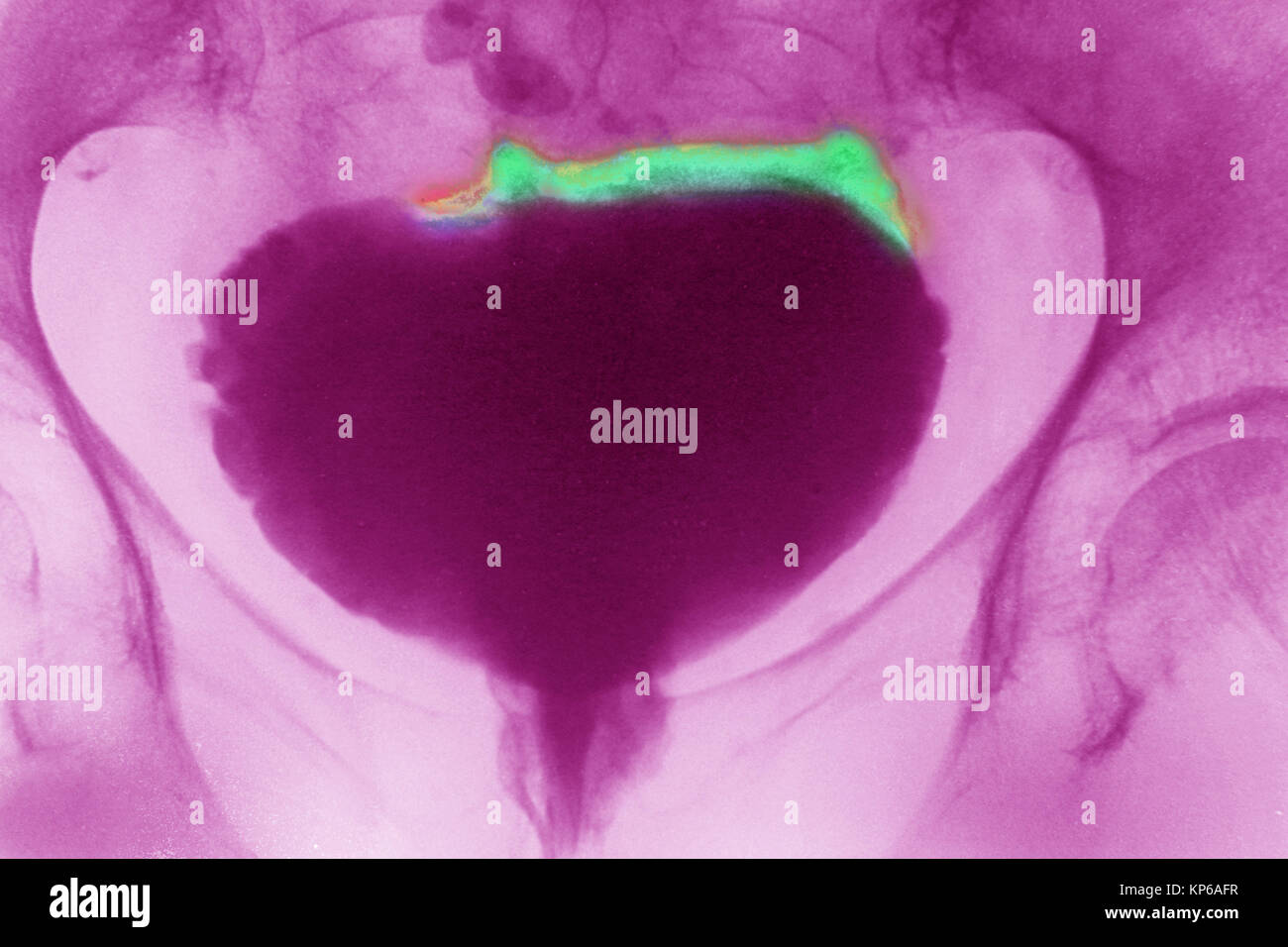 Large Intestine And Bladder High Resolution Stock Photography and ...