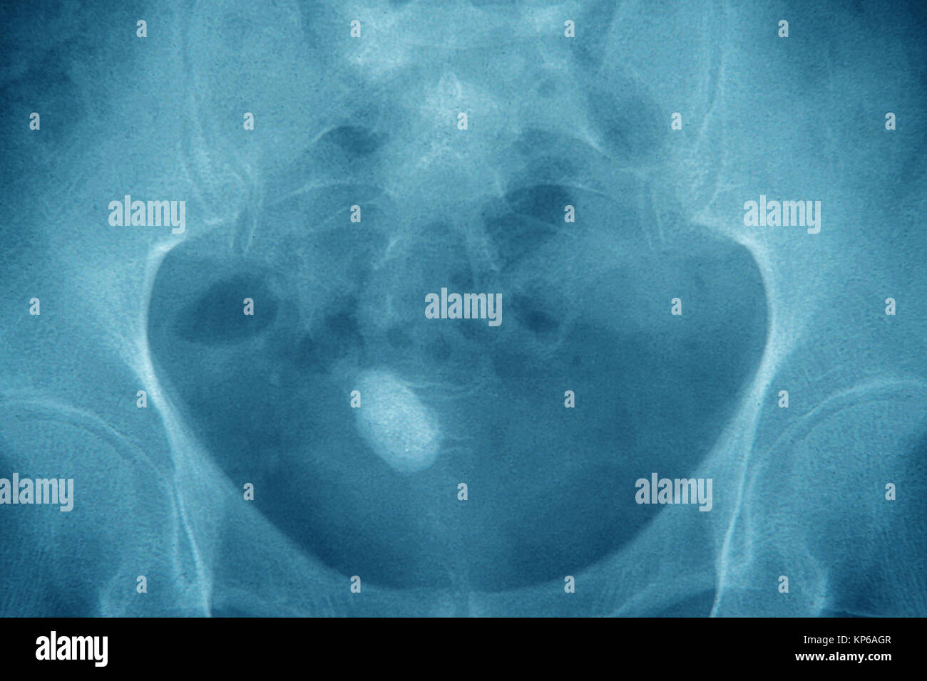 Cystolith hi-res stock photography and images - Alamy