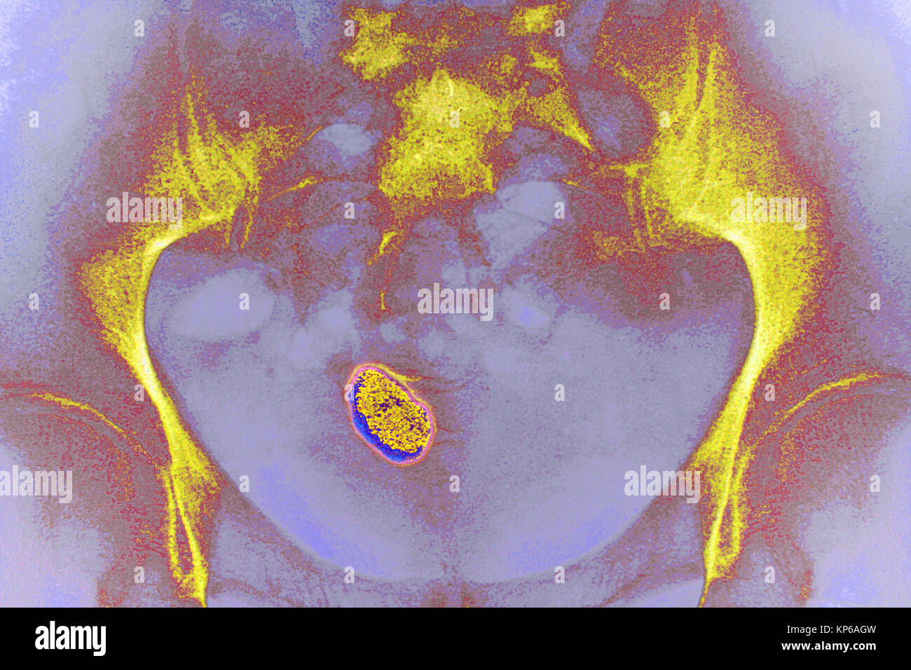 Bladder Stone High Resolution Stock Photography and Images - Alamy
