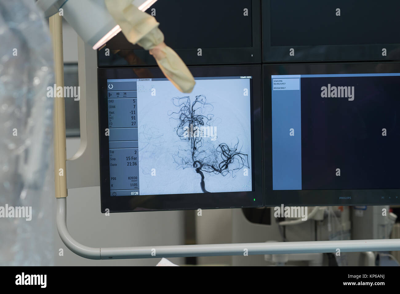 Interventional angiography hi-res stock photography and images - Alamy