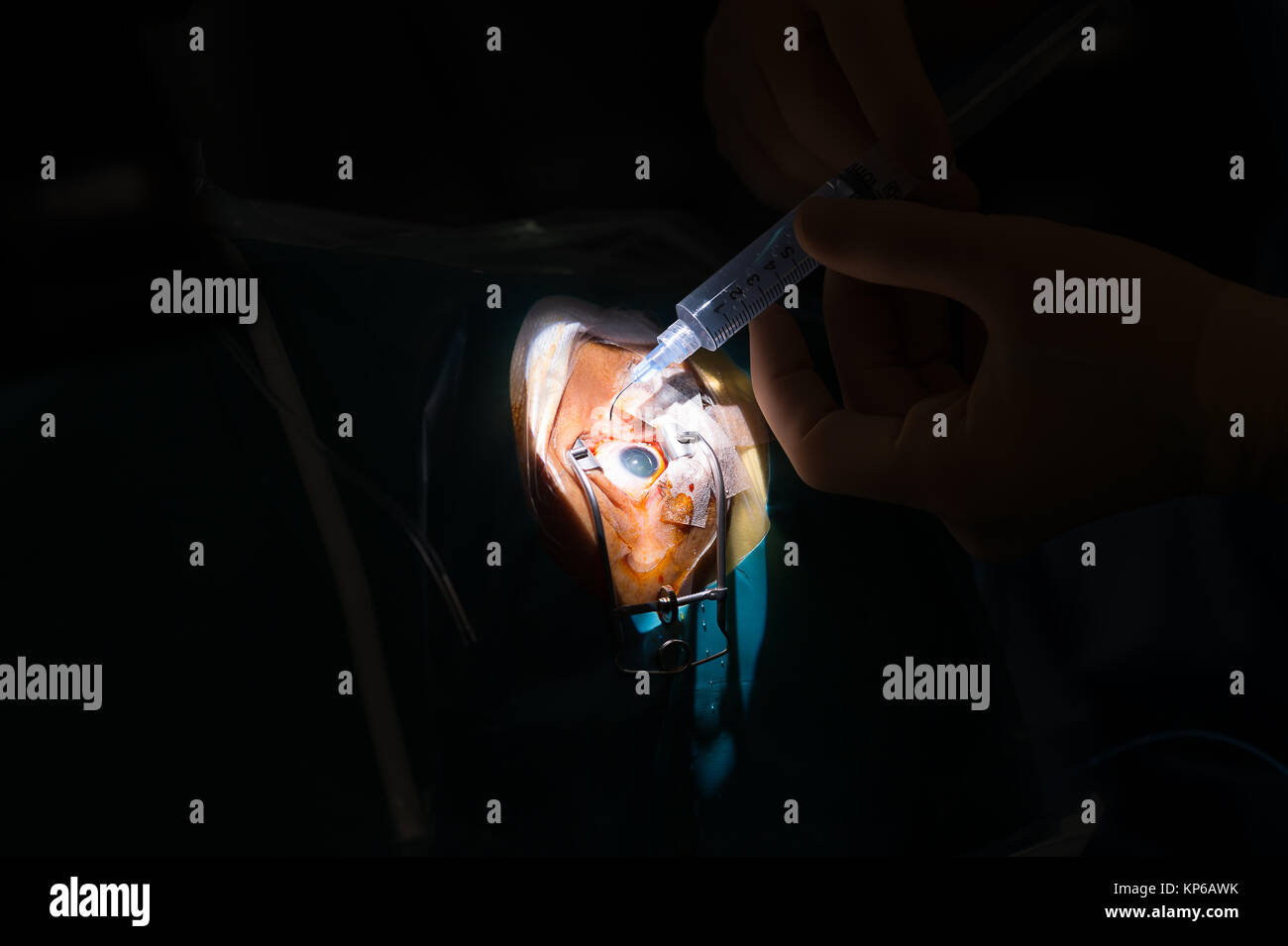 RETINAL DETACHMENT, SURGERY Stock Photo - Alamy