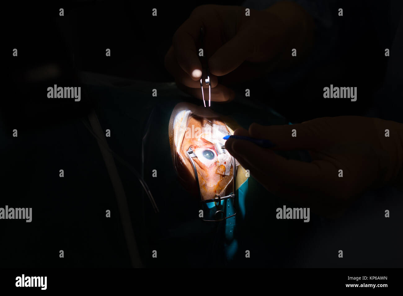 RETINAL DETACHMENT, SURGERY Stock Photo - Alamy