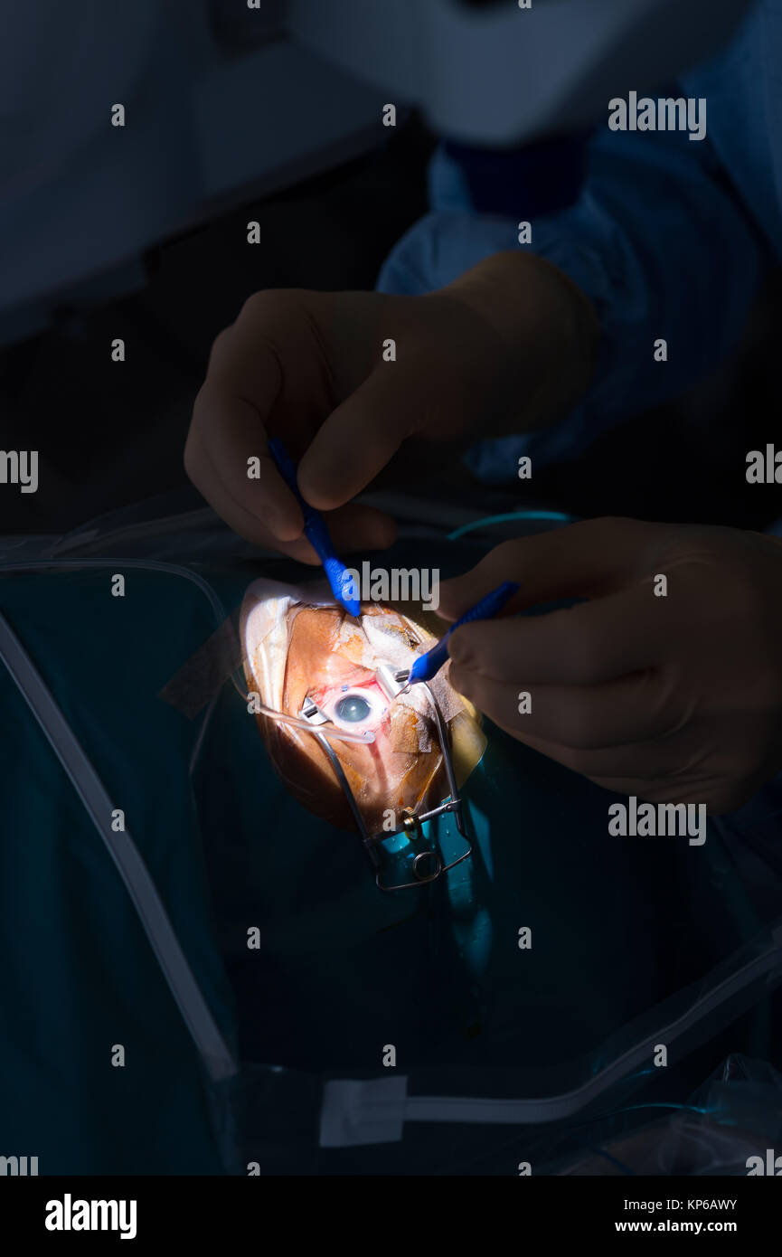 RETINAL DETACHMENT, SURGERY Stock Photo - Alamy