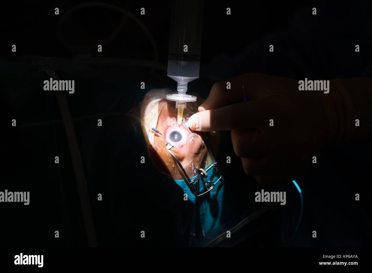 Vitrectomy hi-res stock photography and images - Alamy