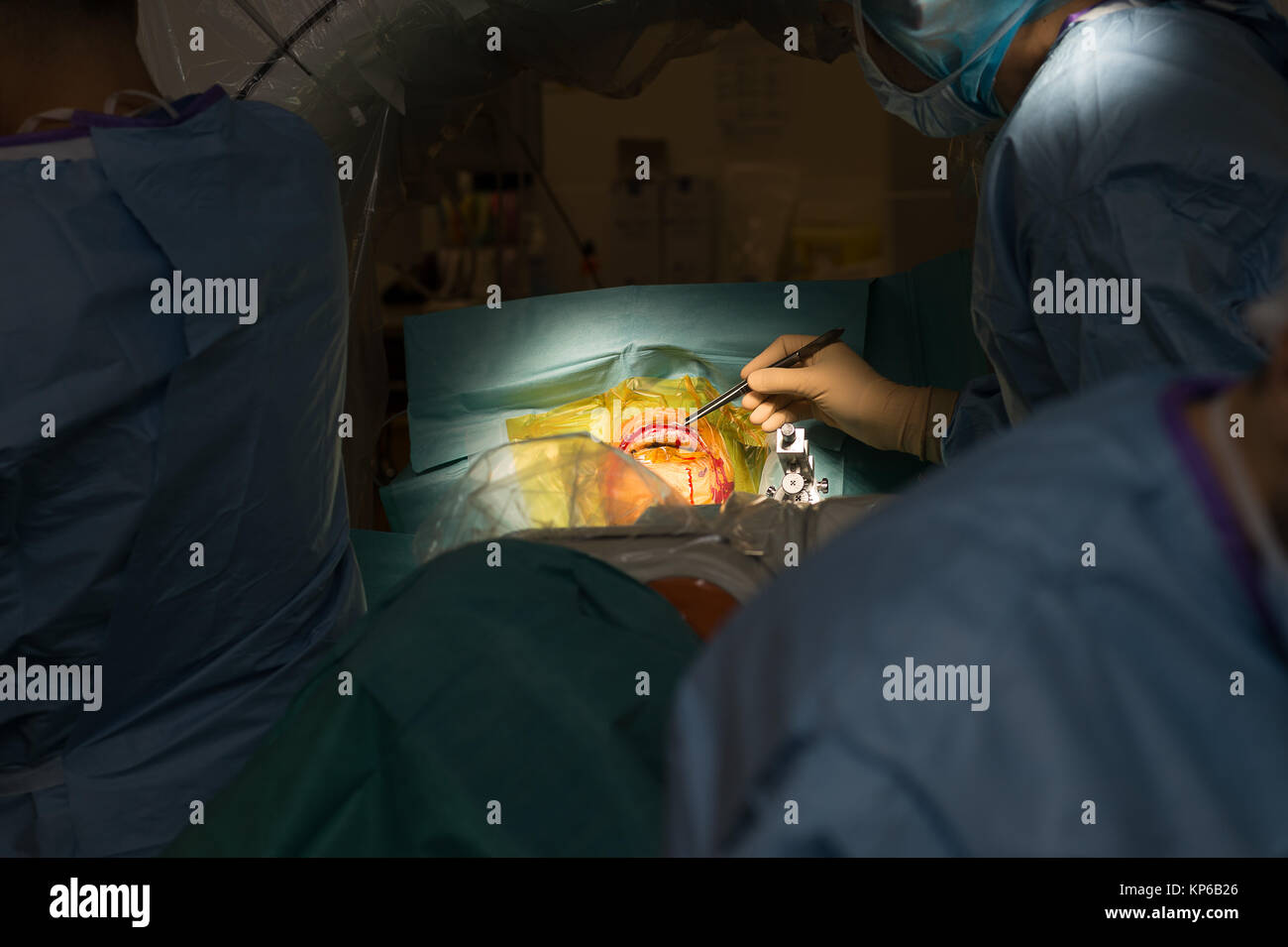DEEP BRAIN STIMULATION Stock Photo - Alamy