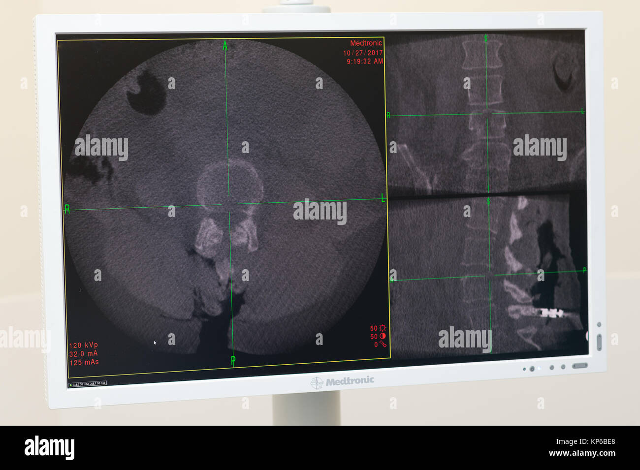 Fluoroscopy surgery hi-res stock photography and images - Alamy