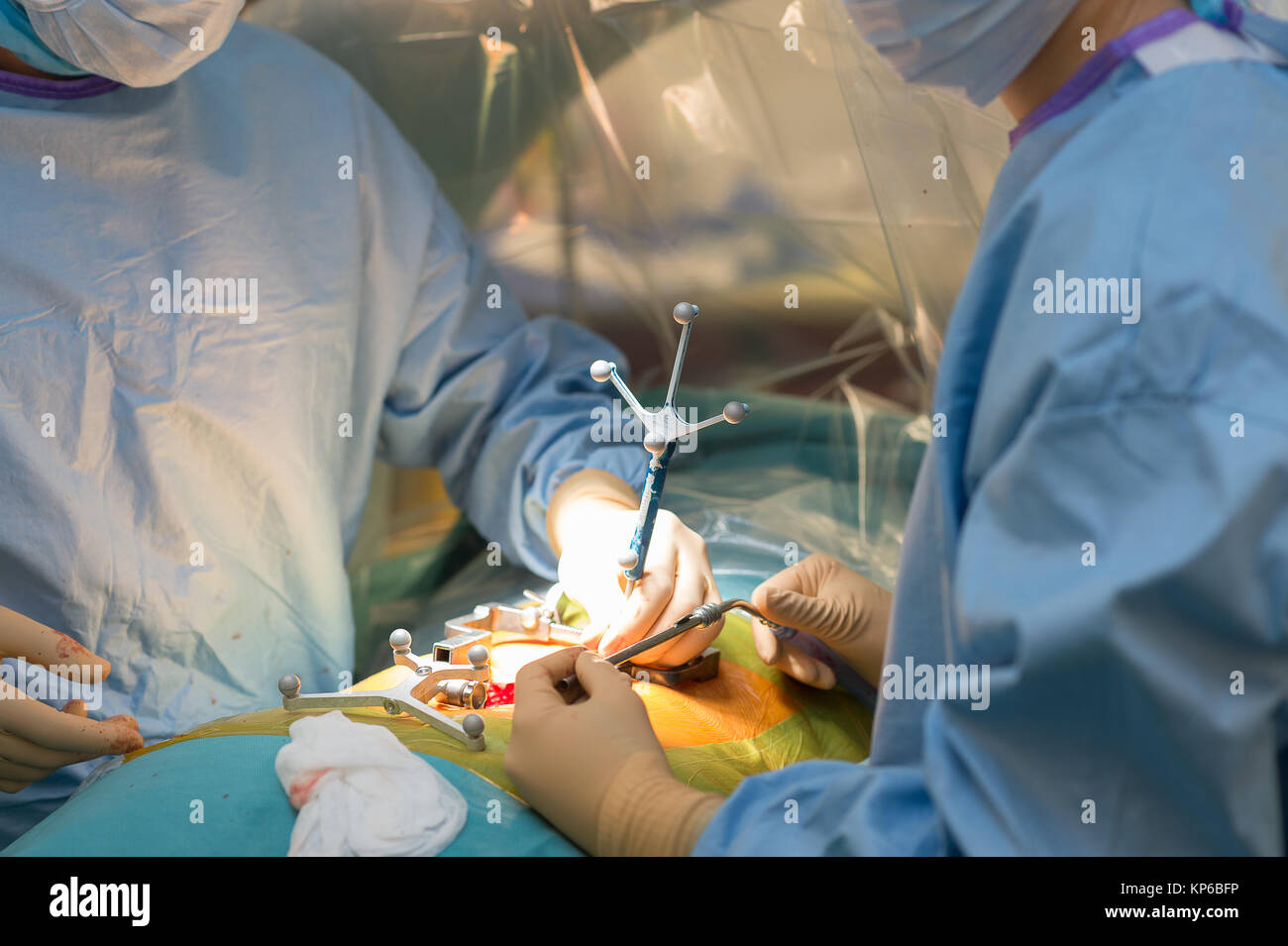 Lumbar spinal stenosis hi-res stock photography and images - Alamy