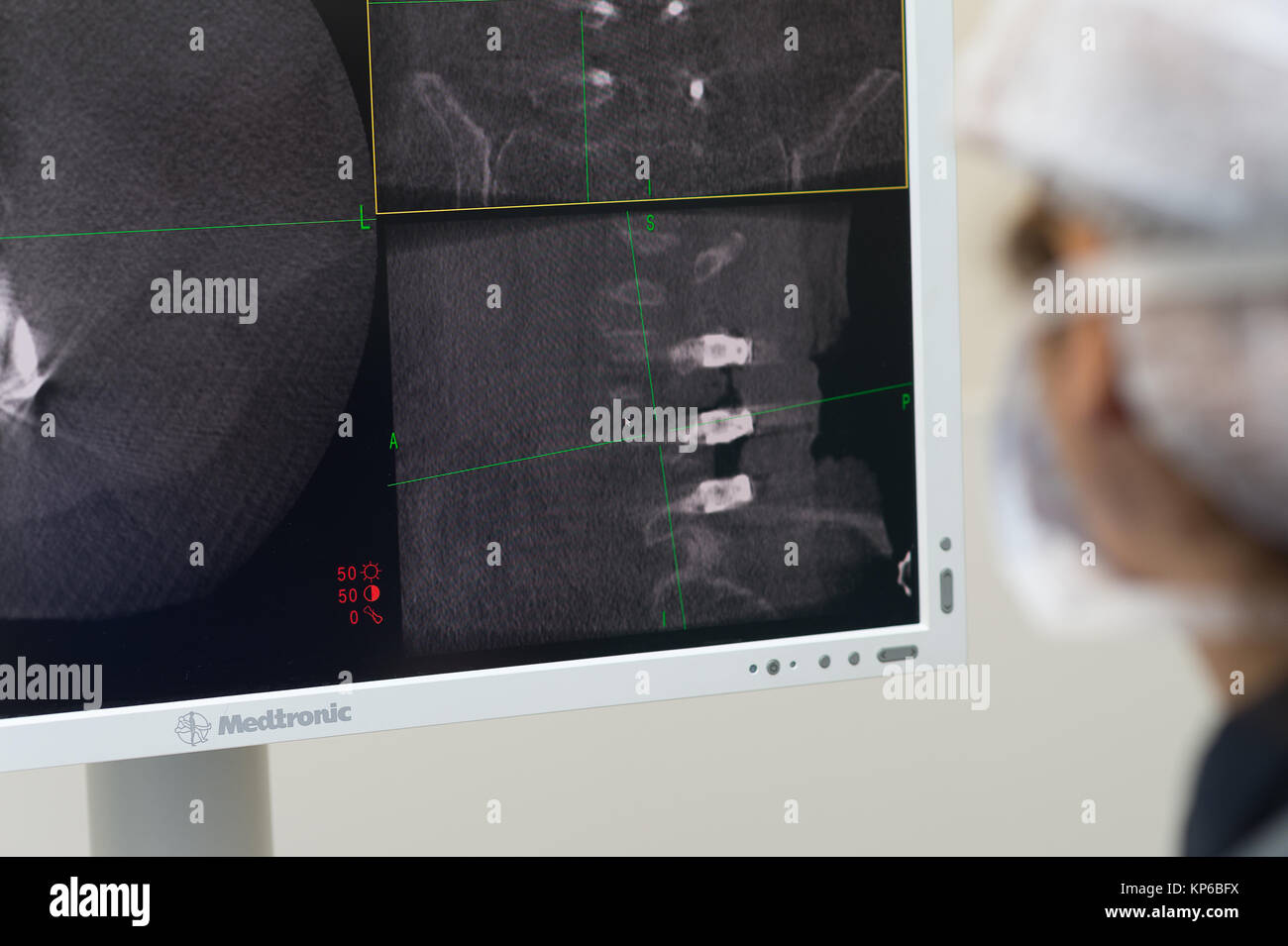 Spine osteosynthesis hi-res stock photography and images - Alamy