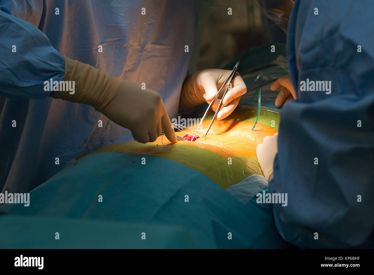 Lumbar spinal stenosis surgery hi-res stock photography and images - Alamy