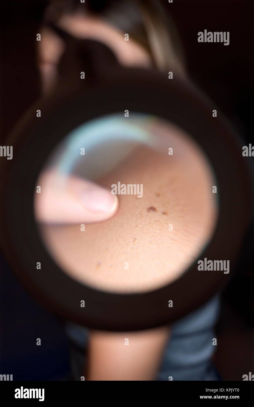 Mole on arm being examined through dermatoscope. The dermatoscope or ...