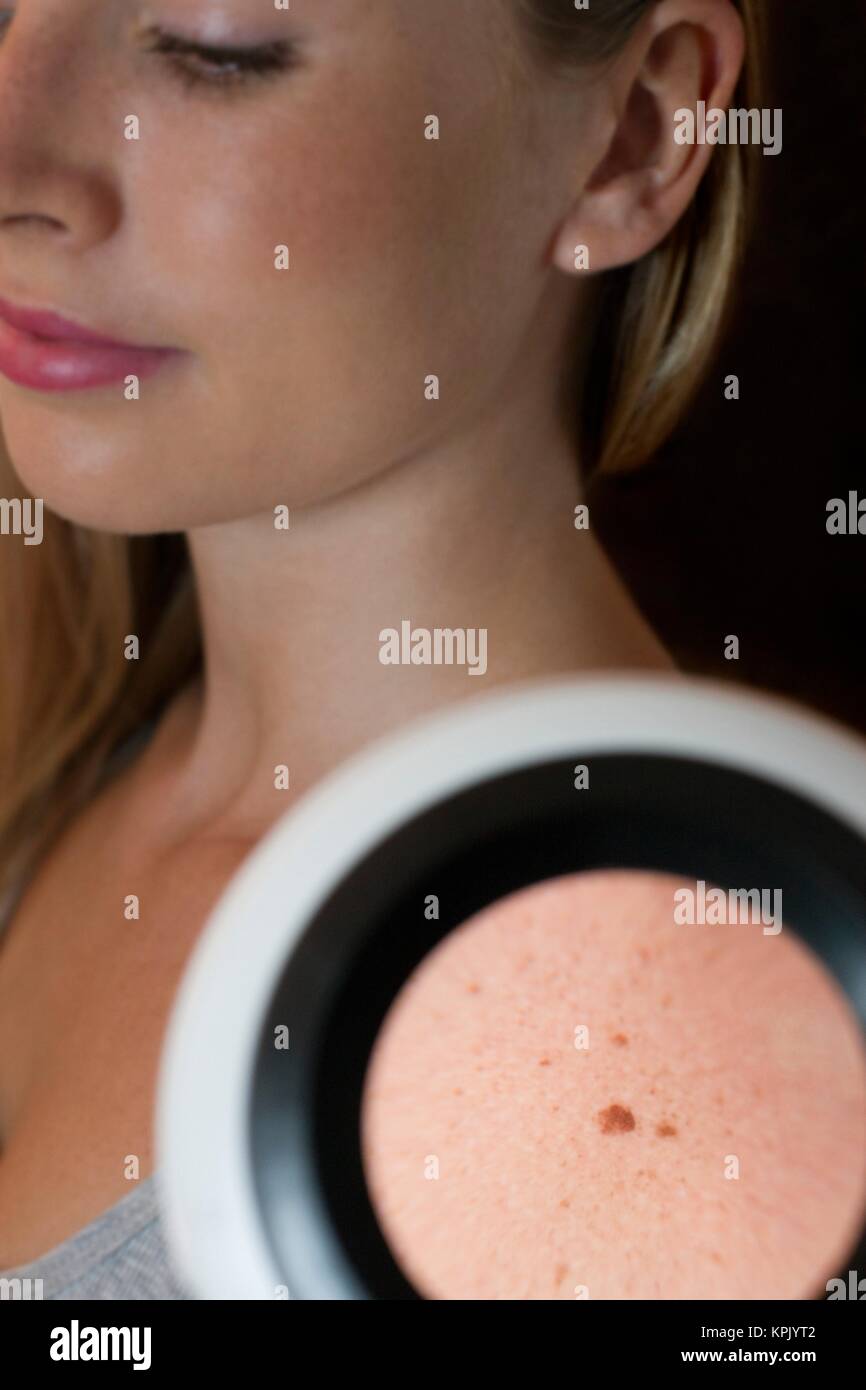 Young woman with mole on shoulder being examined through dermatoscope ...