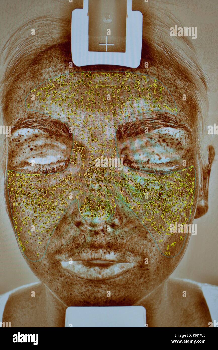 Image of young woman's face undergoing examination in skin clinic. This ...