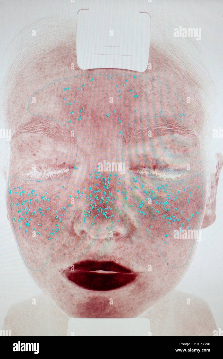 Image of young woman's face undergoing examination in skin clinic. This ...