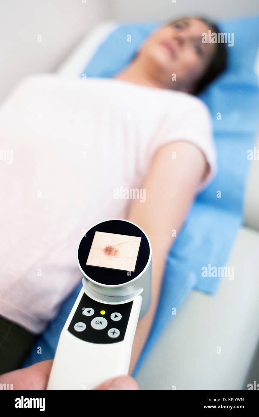 Digital dermatoscope used to examine a mole on a patient's arm Stock ...