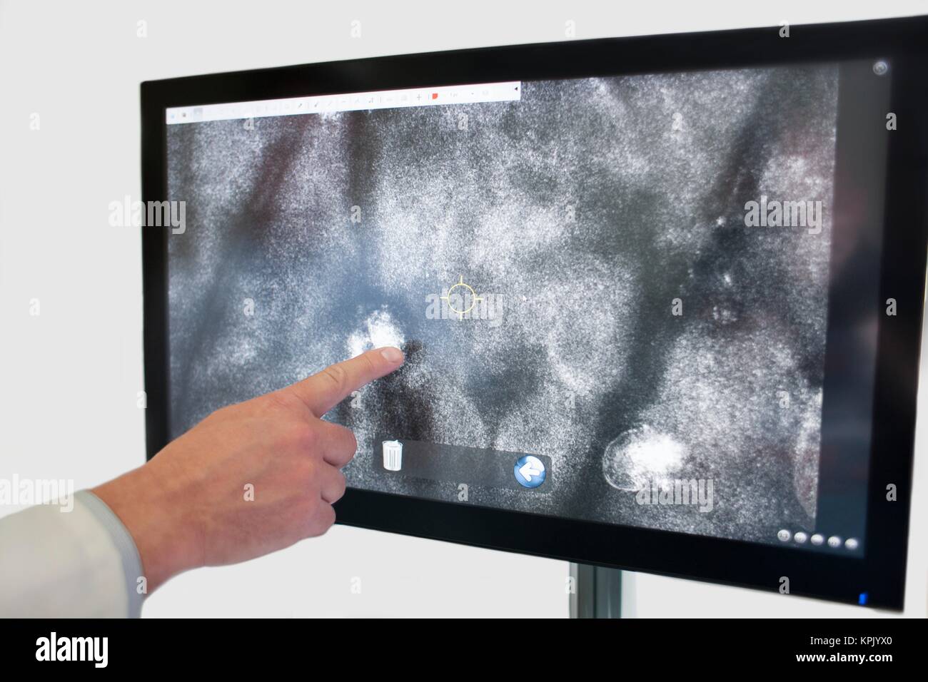 Doctor pointing at computer monitor in skin clinic. On the screen is ...