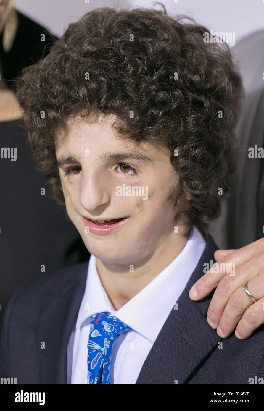 Treacher Collins Syndrome Nathaniel Newman