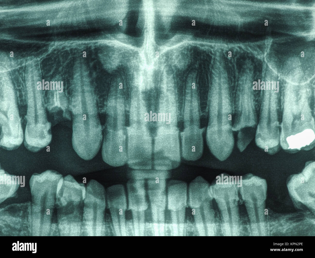 Teeth xray hi-res stock photography and images - Alamy