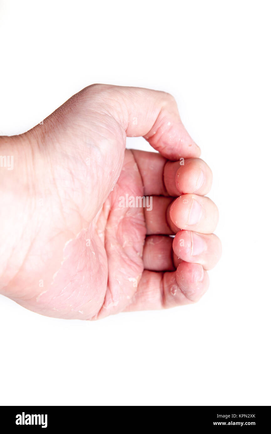 Eczema Atopic Dermatitis Symptom Skin High Resolution Stock Photography and Images - Alamy