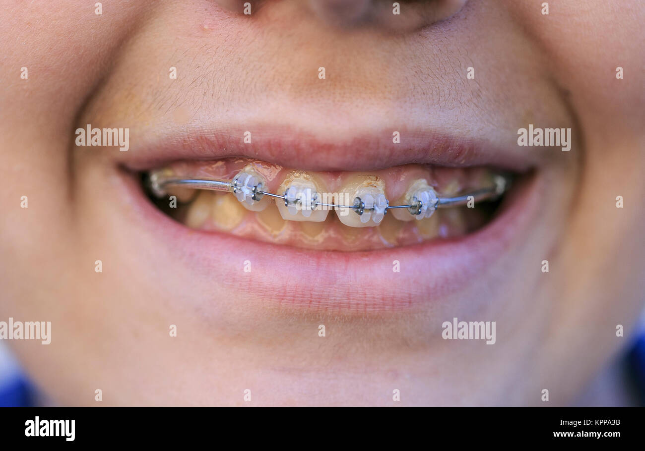 Brackets people human human hi-res stock photography and images - Alamy