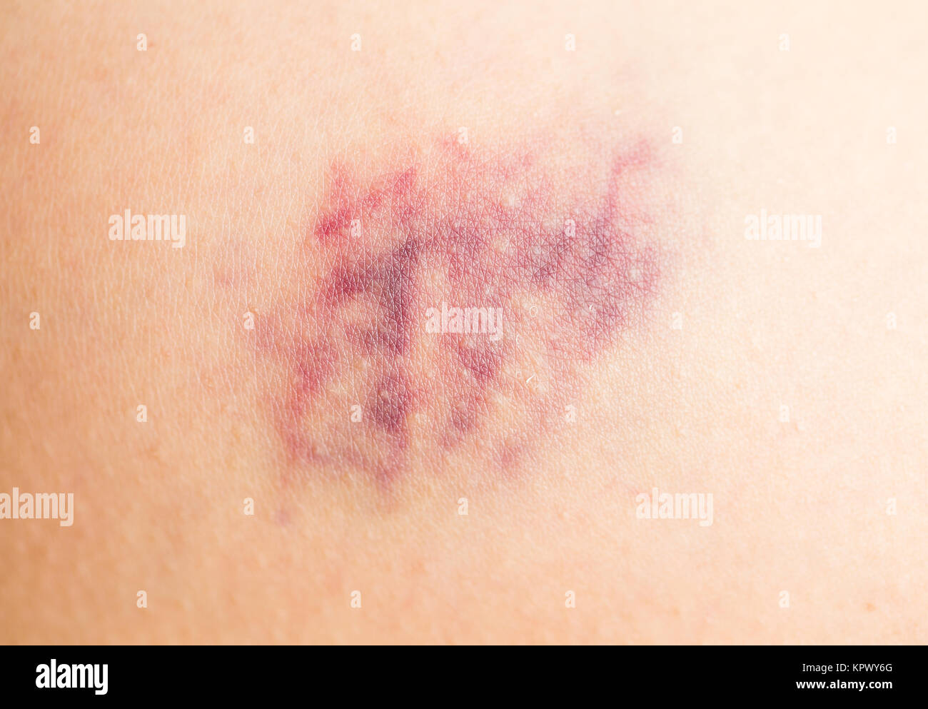 Blunt Trauma Stock Photos & Blunt Trauma Stock Images - Alamy