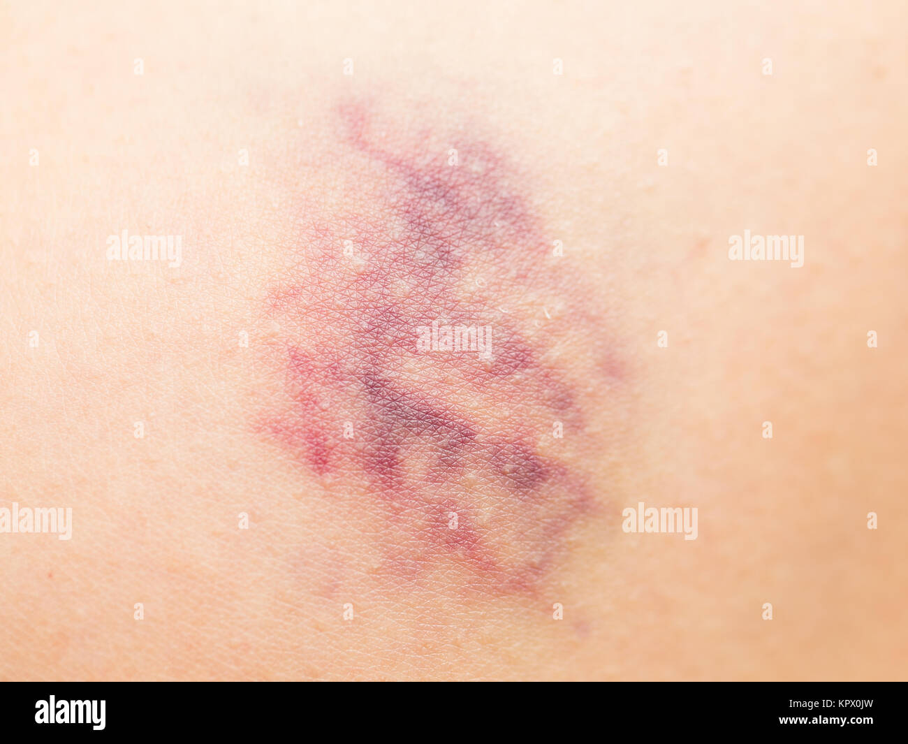 Skin Swollen High Resolution Stock Photography and Images - Alamy