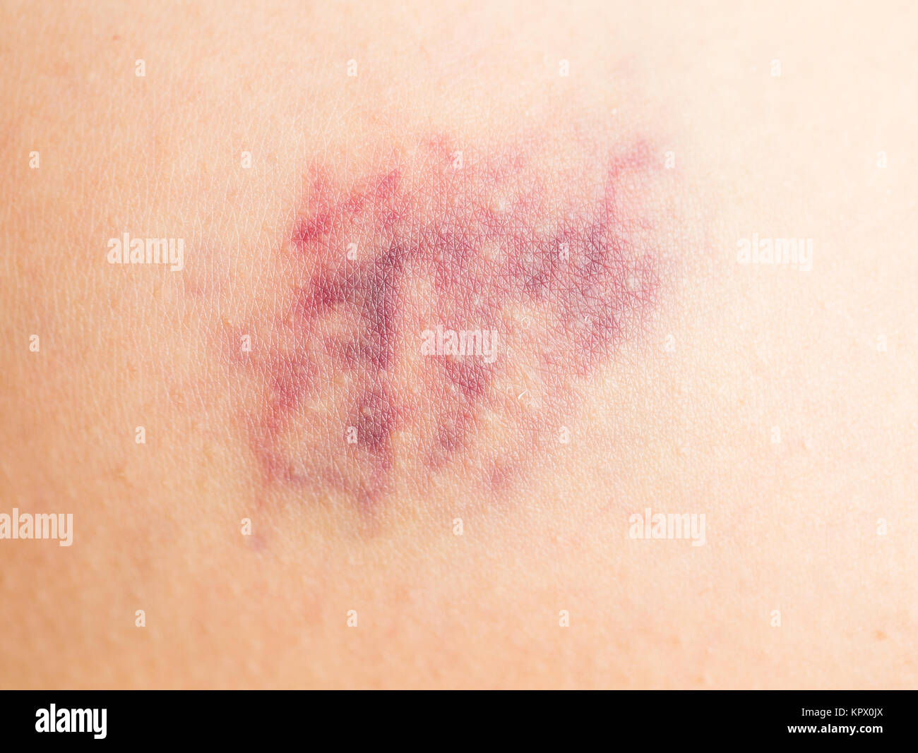Blunt Trauma Stock Photos & Blunt Trauma Stock Images - Alamy