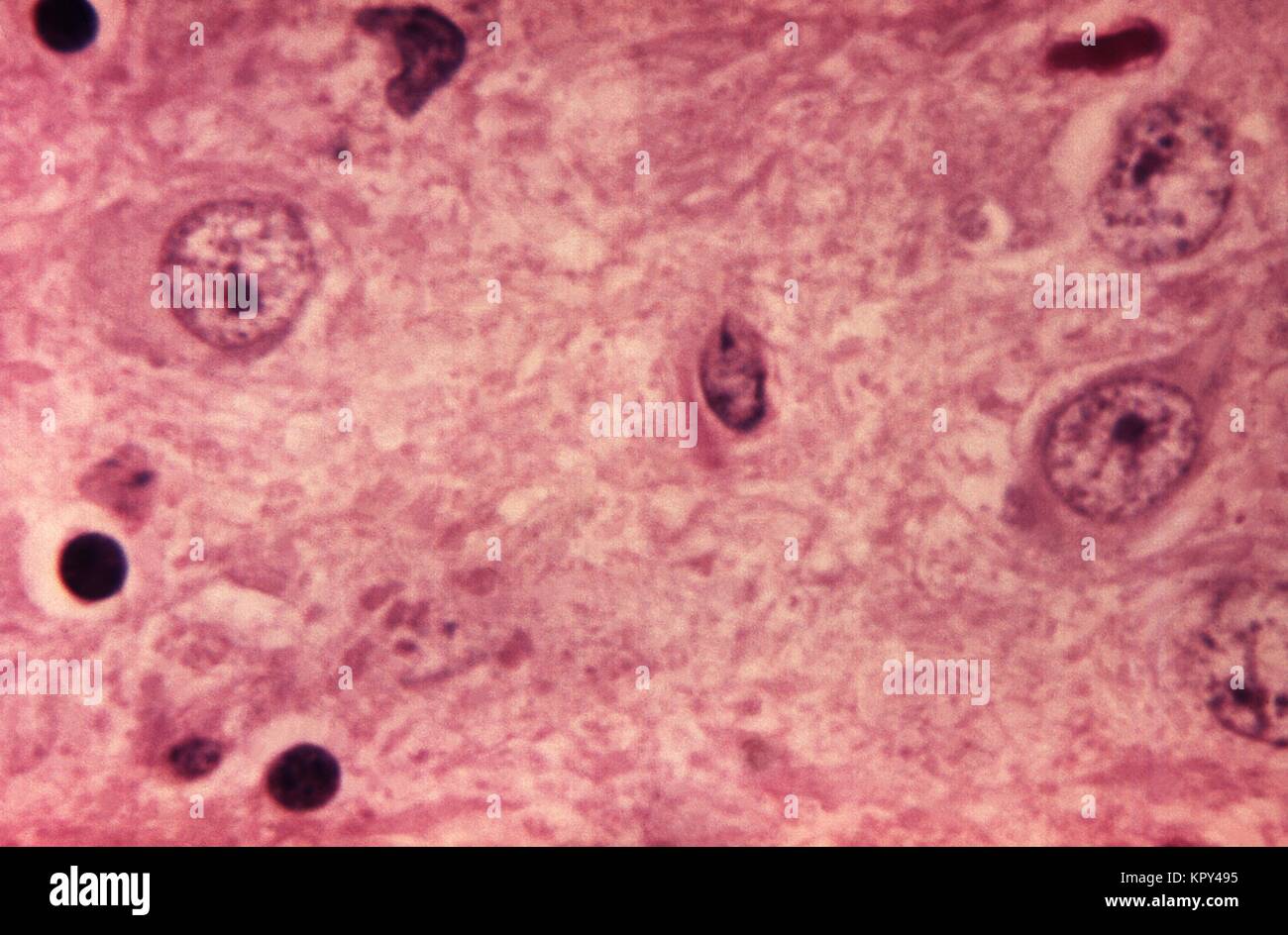 Micrograph revealing histopathologic hi-res stock photography and ...