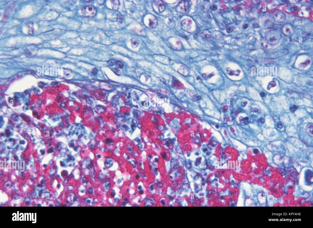 Micrograph revealing histologic changes in human skin infected with the ...