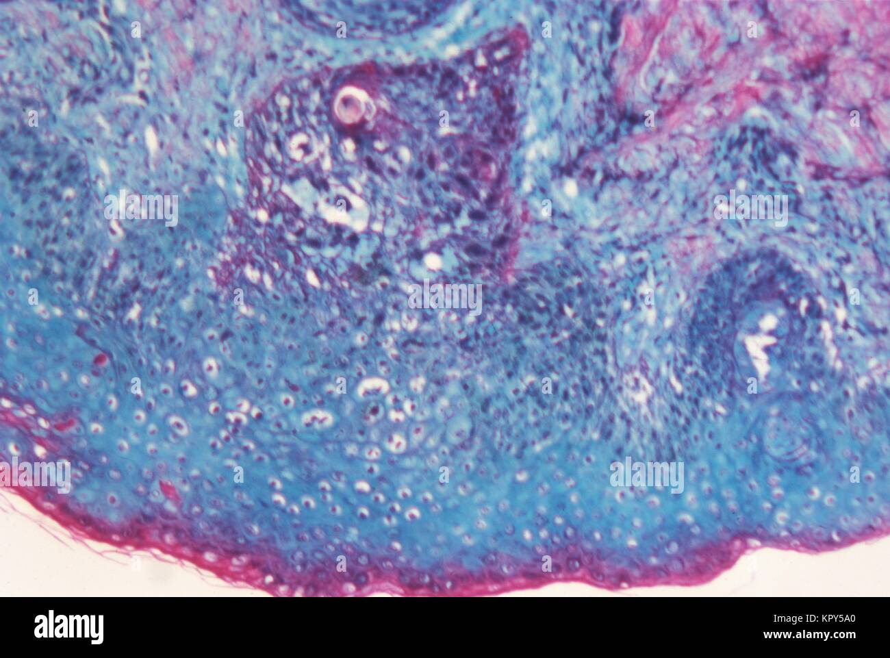 Micrograph of histologic changes in human skin infected with the ...