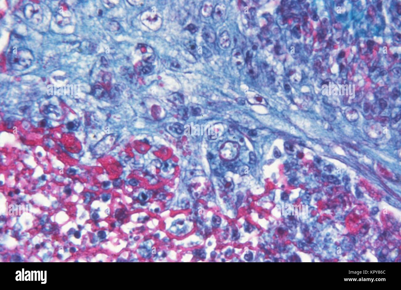 Micrograph showing the histologic changes in human skin that has been ...