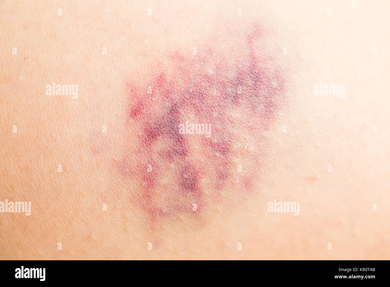 Bruise on wounded woman skin Stock Photo - Alamy
