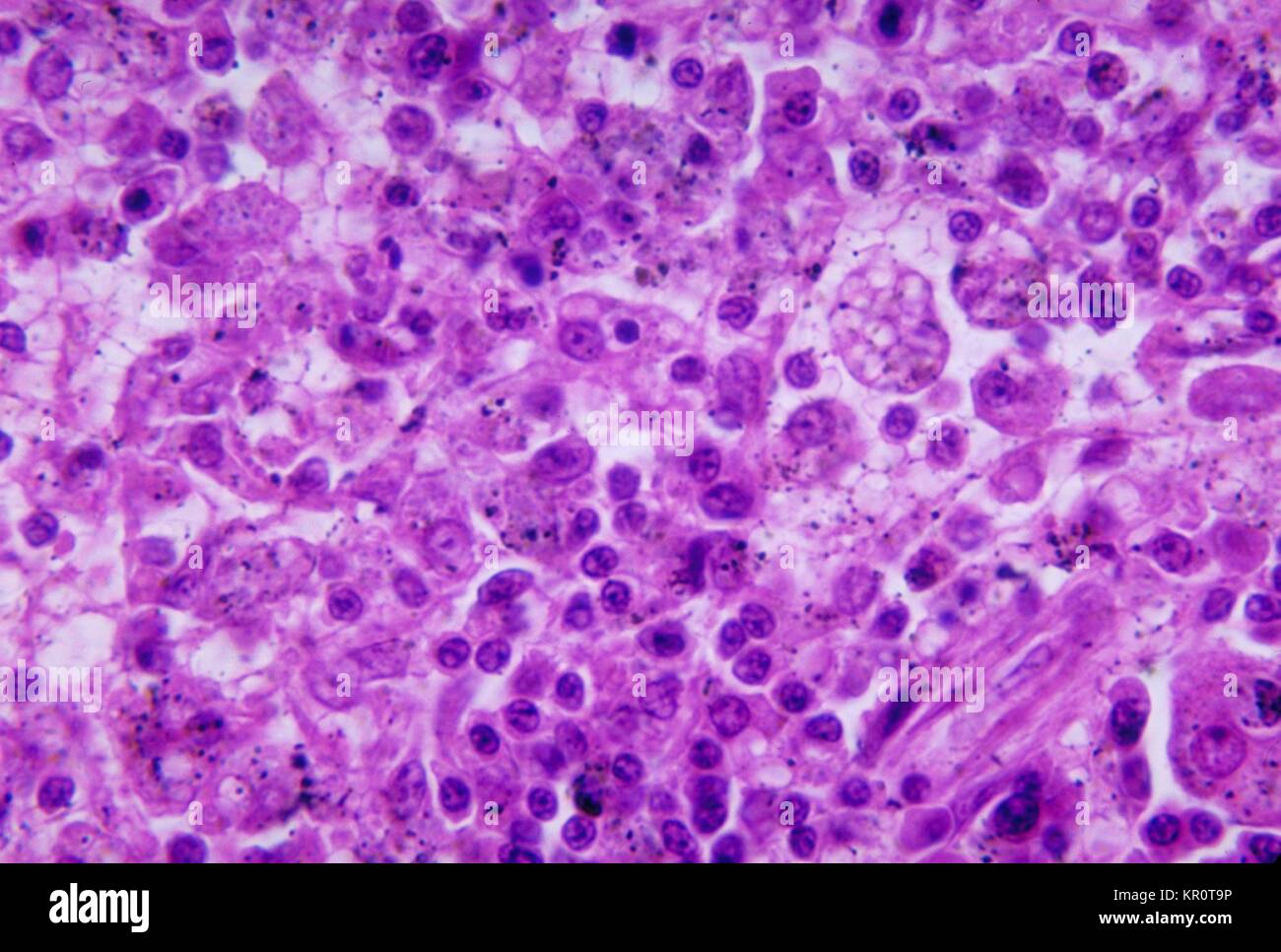 This micrograph depicts the histopathologic changes associated with ...