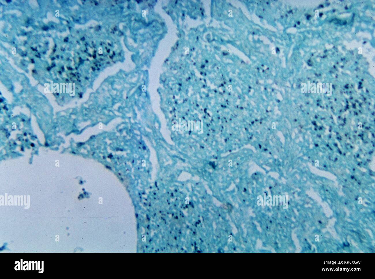 Methenamine silver stain hi-res stock photography and images - Alamy