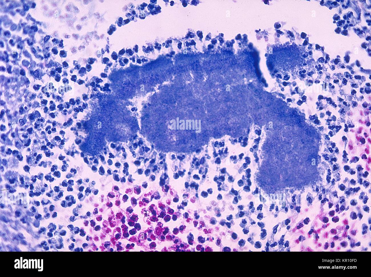 This micrograph depicts histopathologic changes due to the gram ...