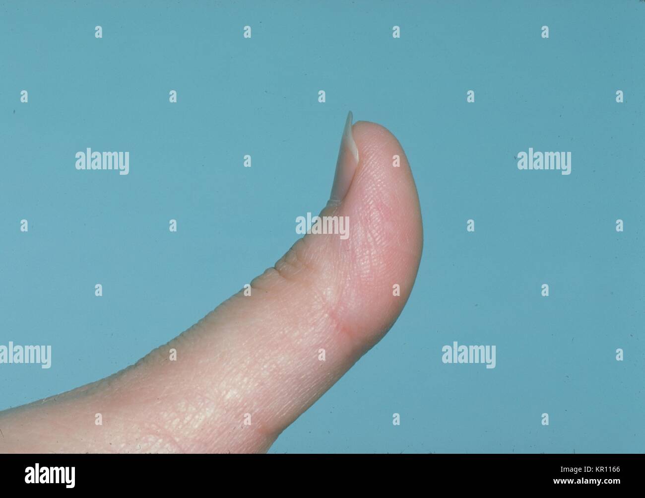 This patient presented with sporotrichosis affecting the skin of the ...