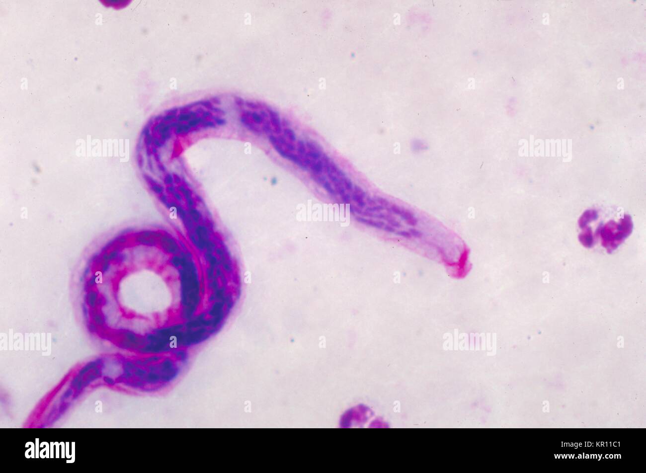 Wuchereria Bancrofti Microfilaria In A Blood Smear