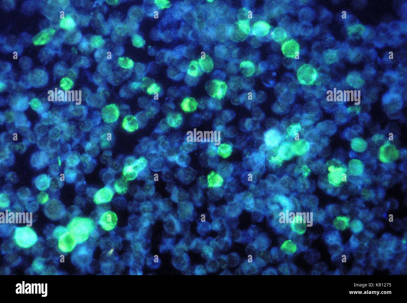 This photomicrograph depicts leukemia cells that contain Epstein Barr ...