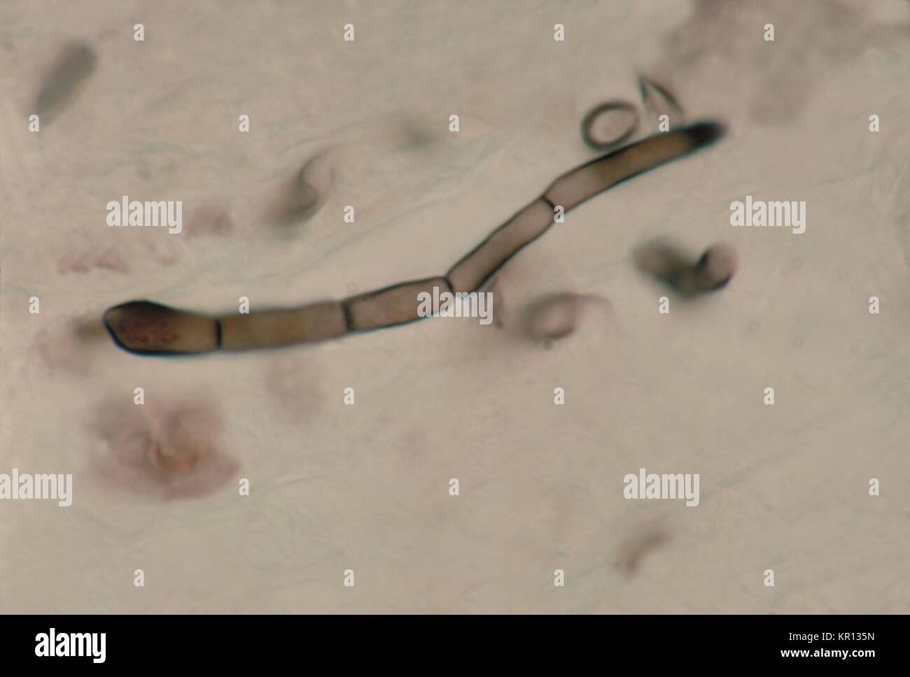 A micrograph revealing histopathologic changes in phaeohyphomycosis due ...