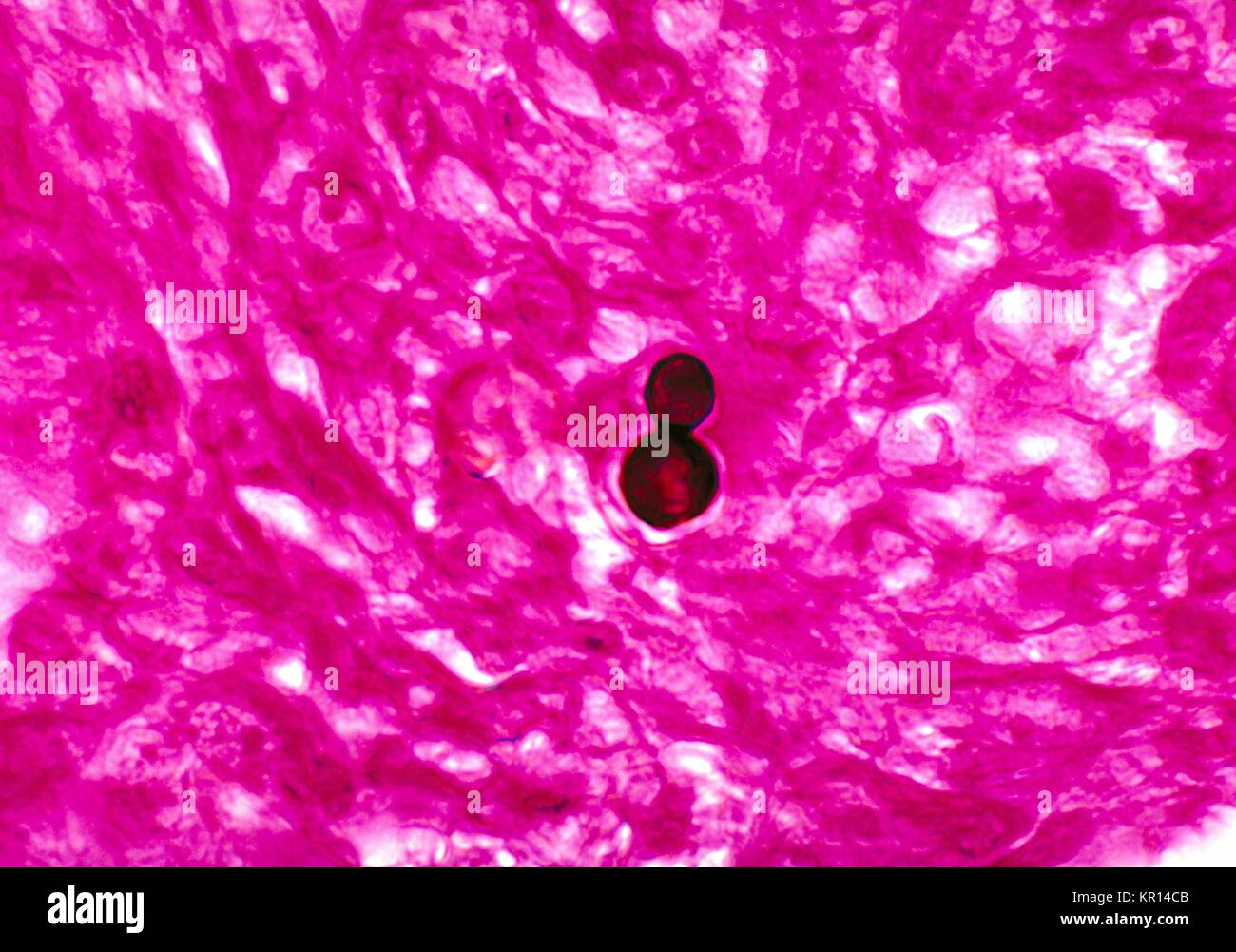 This photomicrograph depicts the fungal agent Blastomyces dermatitidis ...