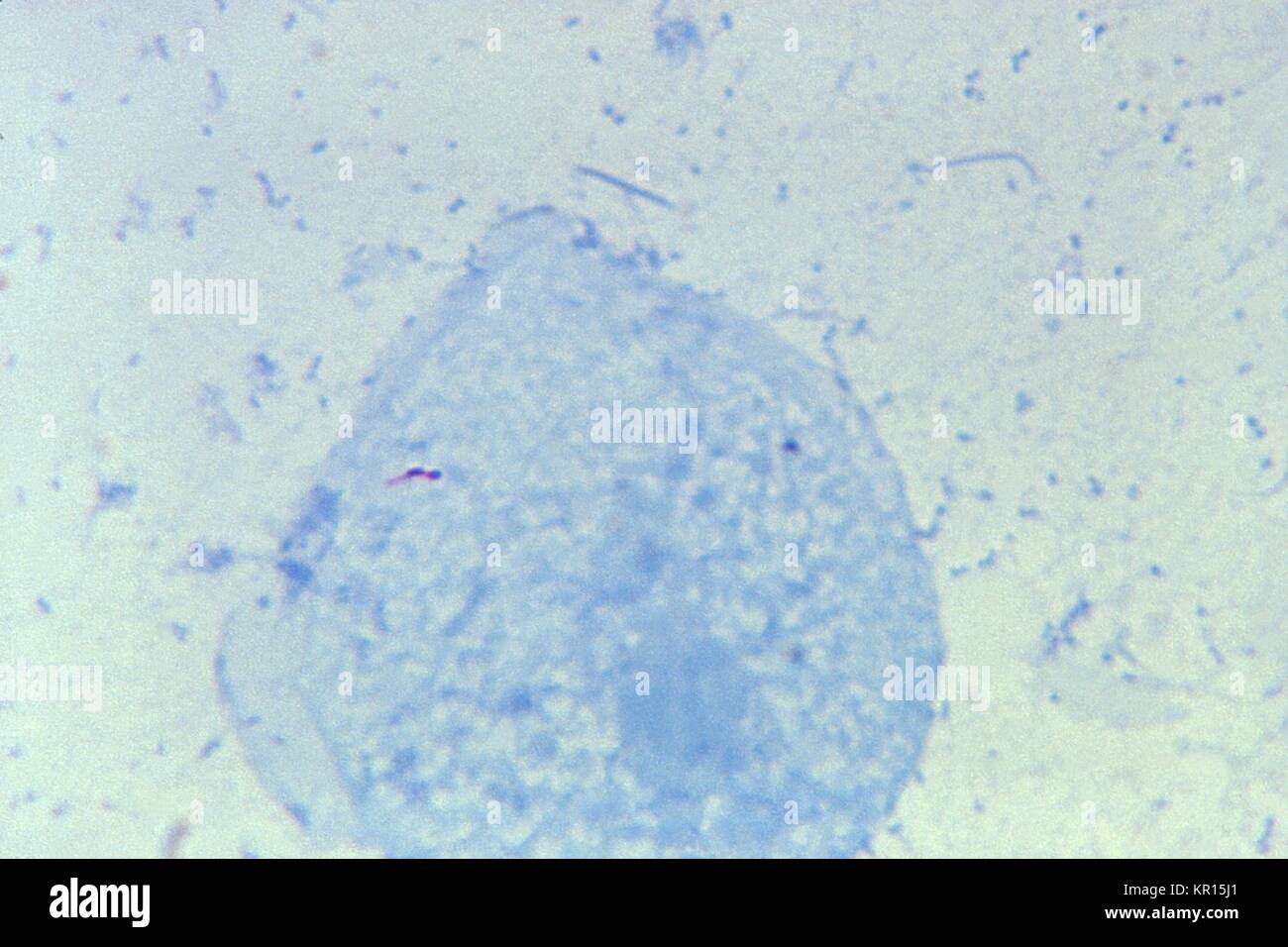 Here Mycobacterium tuberculosis in a sputum smear is stained using the ...