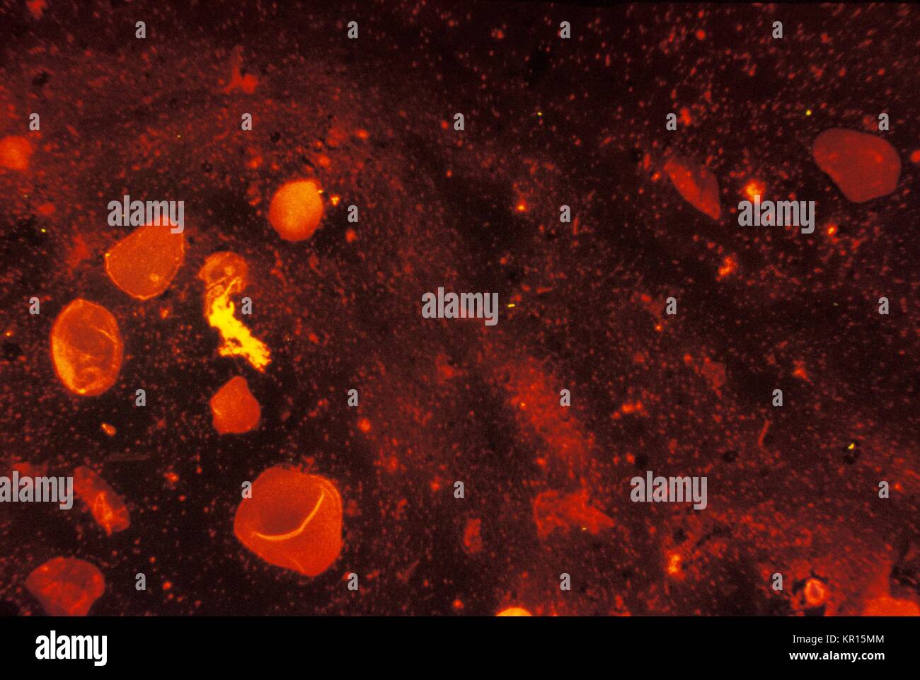 Here we see Mycobacterium tuberculosis in a sputum smear is stained ...