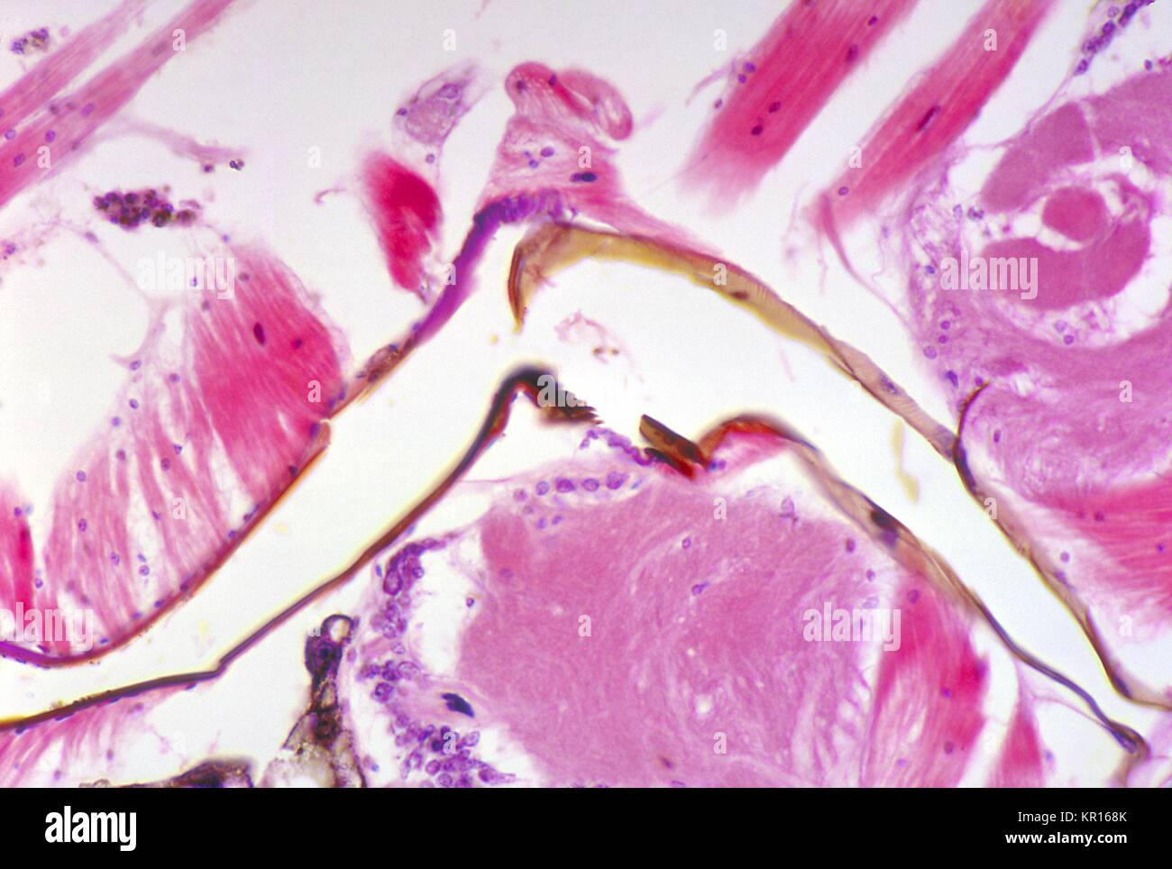 A photomicrograph revealing the histology of Onchocerca volvulus ...