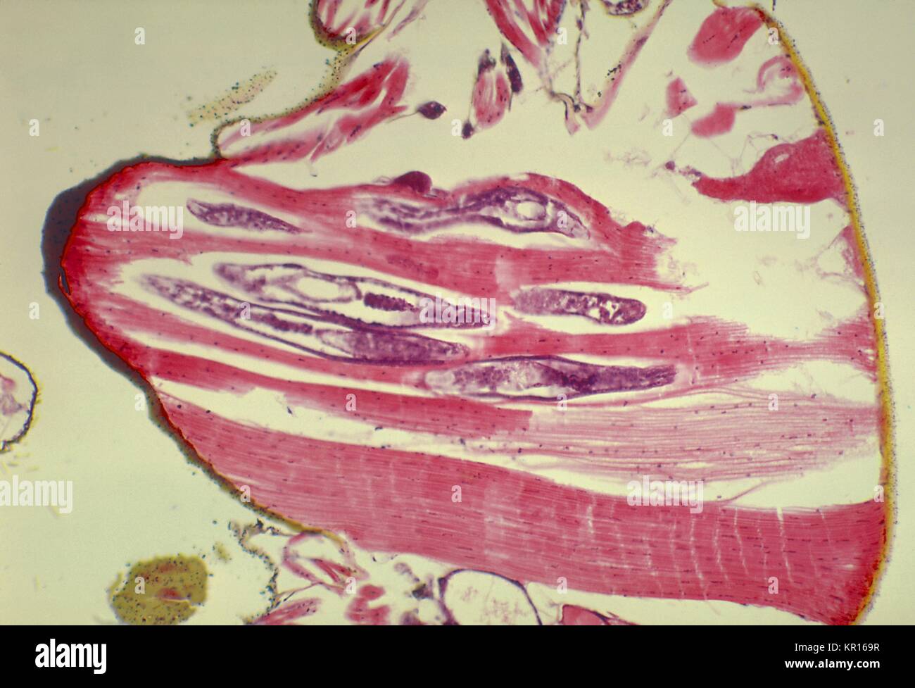 A photomicrograph revealing the histology of Onchocerca volvulus ...