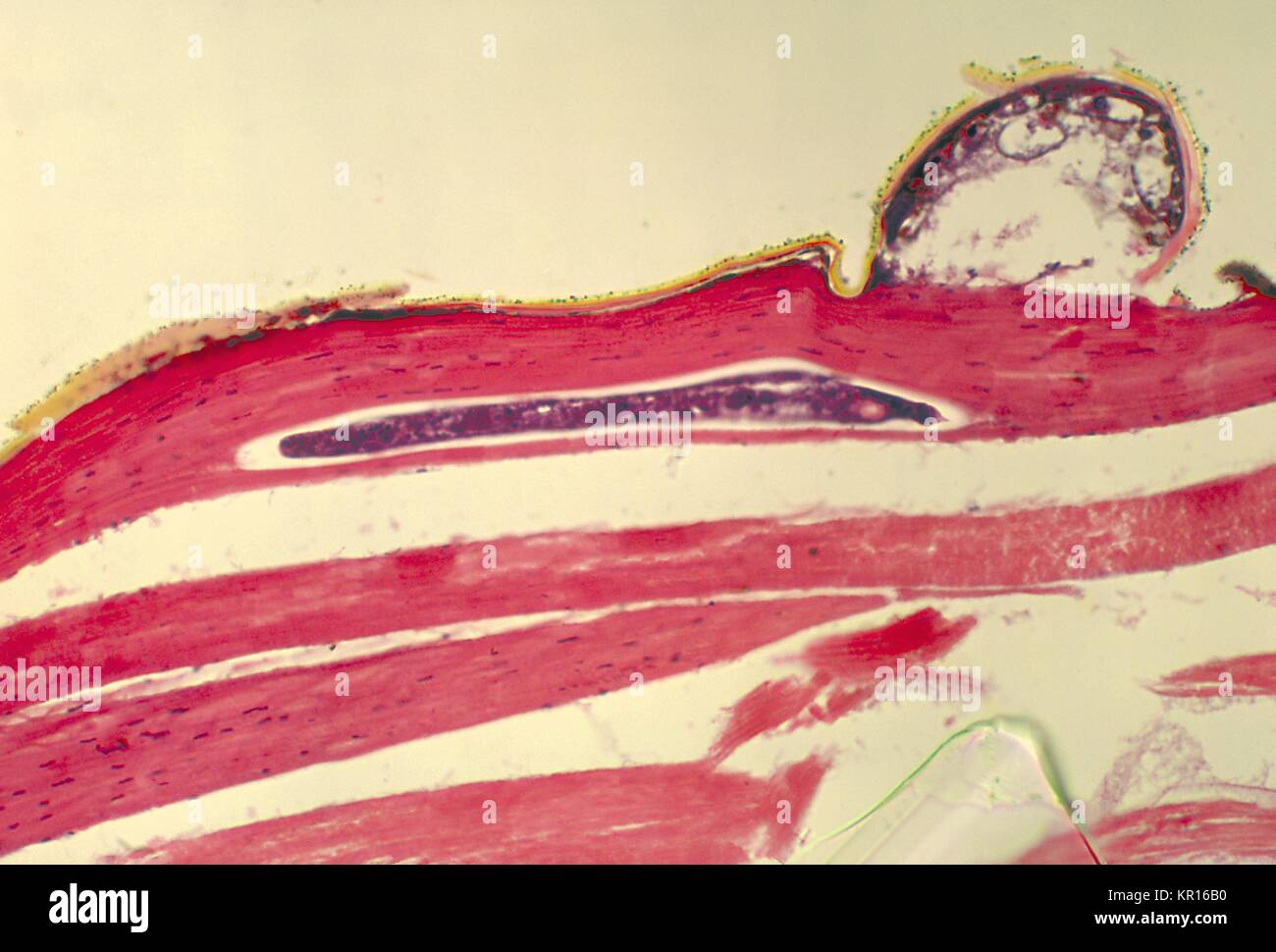 A photomicrograph revealing the histology of Onchocerca volvulus ...