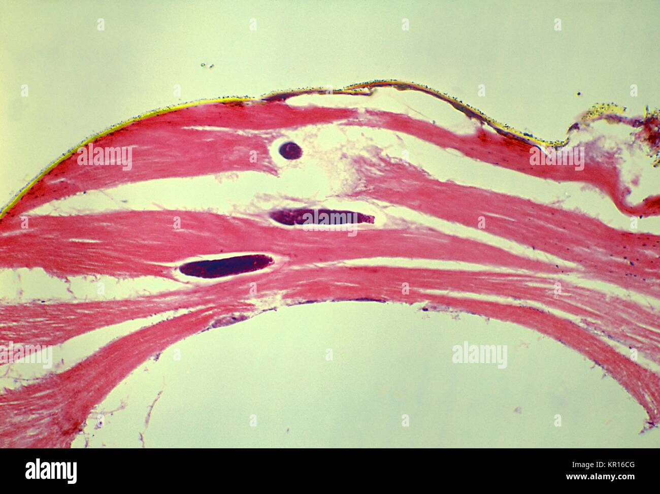 A photomicrograph revealing the histology of Onchocerca volvulus ...