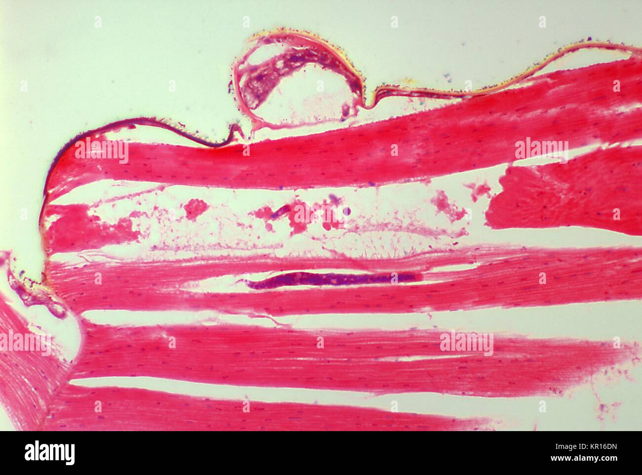 Onchocerca volvulus parasitic worm hi-res stock photography and images ...